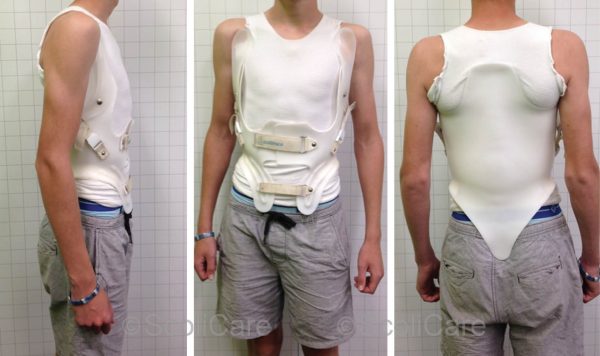Case Study - 61° Hyperkyphosis Treatment With Kyphobrace