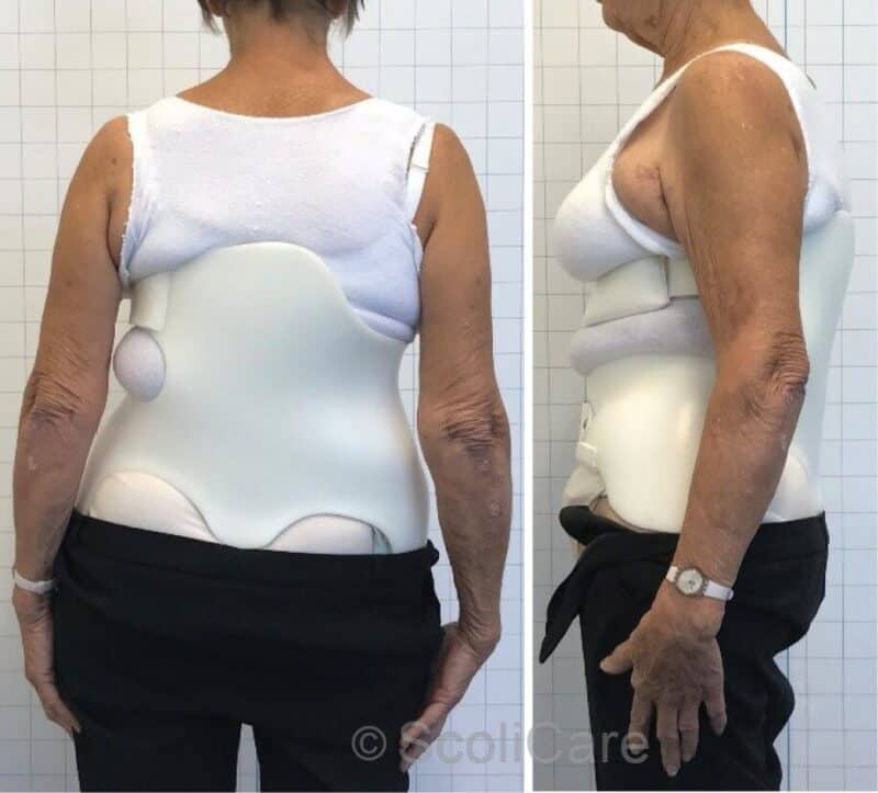 Case Study - Relief Scoliosis in Elderly With ScoliBrace