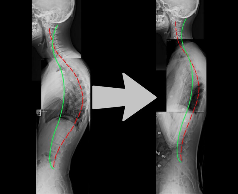 Correct Your Poor Posture in Midvale Utah
