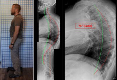 Case Study Kyphosis Treatment in Adults (Before & After)