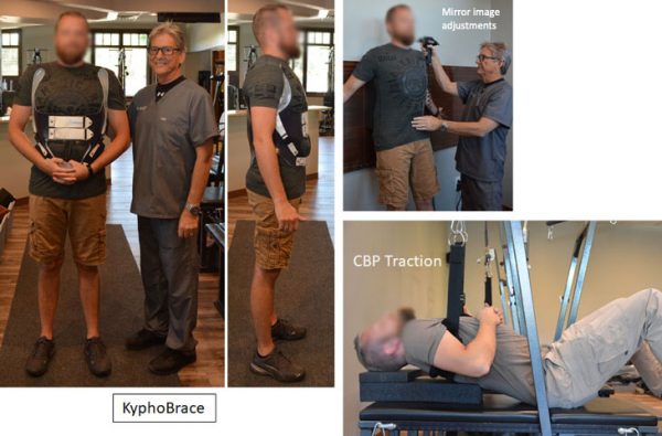 Case Study Kyphosis Treatment in Adults (Before & After)