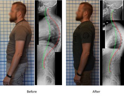 Case Study Kyphosis Treatment in Adults (Before & After)